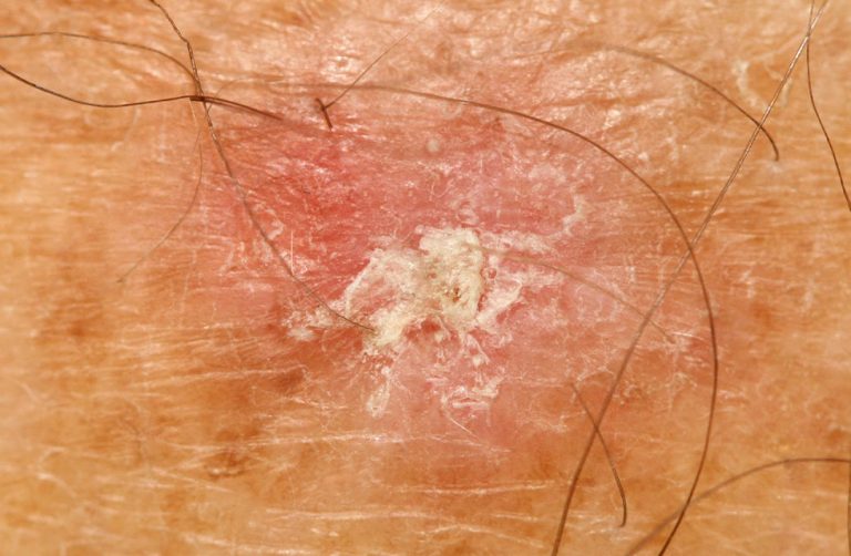 Solar Keratosis - Ballarat Skin Cancer Centre